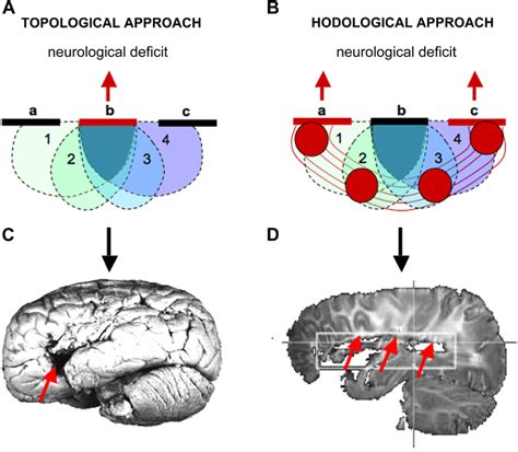 Figure 1 From The Arcuate Fasciculus And The Disconnection Theme In Language And Aphasia