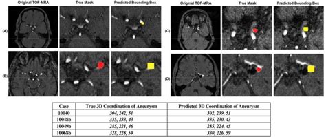 Nndetection For Intracranial Aneurysms Detection And Localization Paper And Code Catalyzex