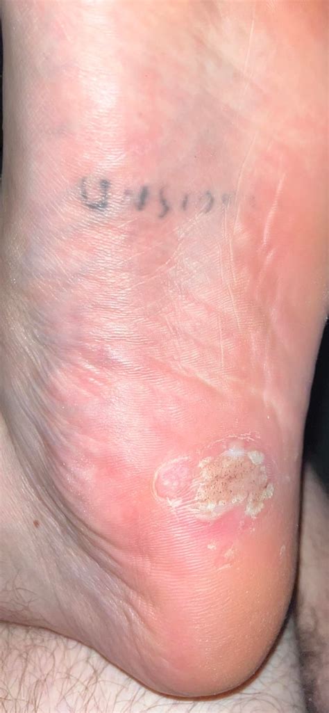 Vircin 1 Month In Rwarts