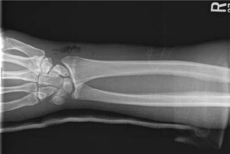 Three Looped Penrose Drains Placed To Fully Drain All Extents Of