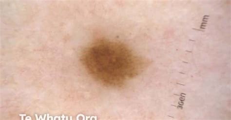 Melanocytic Naevus Image