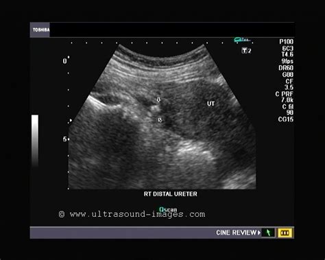 Ultrasound Imaging Distal Ureteral Calculus