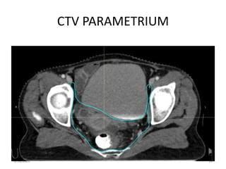 Target Delineation In Cervix Cancer By Dr Kanhu Pptx