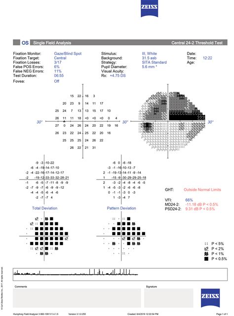 Standard 24 2 Visual Fields May Underestimate Central Progression