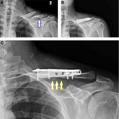 A Preoperative X Ray Of The 45 Years Old Male Patient Download