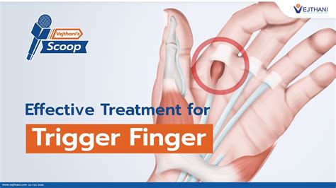 Effective Treatment for Trigger Finger | Vejthani's Scoop - YouTube