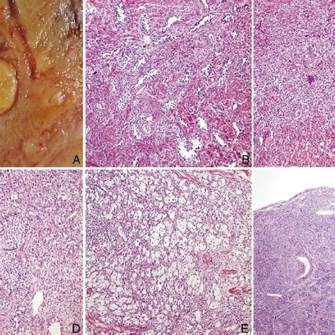 PDF Uterine Tumors Resembling Ovarian Sex Cord Stromal Tumors Synchronous Uterine Tumors
