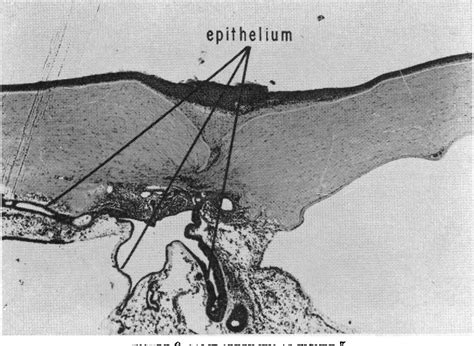 Figure 6 From Epithelization Of The Anterior Chamber Semantic Scholar