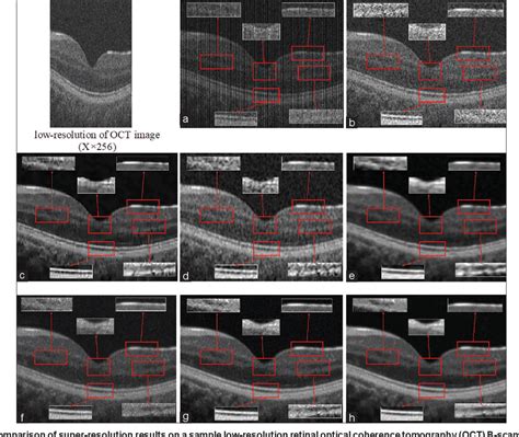 Figure 1 From Super Resolution Of Retinal Optical Coherence Tomography