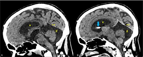 Non Contrast Enhanced Computed Tomography Of Head Preoperatively A Download Scientific