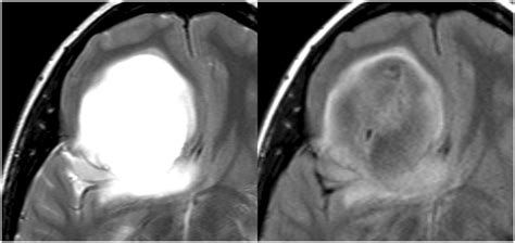An Example Of T2 Flair Mismatch Sign A Patient With Idh Mutant Download Scientific Diagram