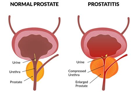 5 Common Prostate Problems And How Assisted Living In South Valley Nm Can Help Morada Senior