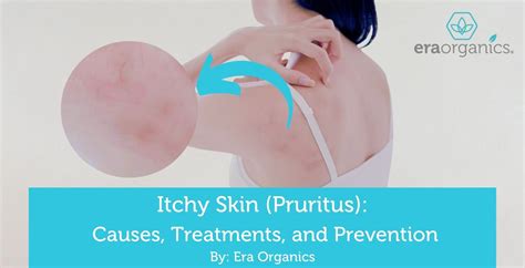 Itchy Skin Pruritus Causes Treatments And Prenvetion Era Organics