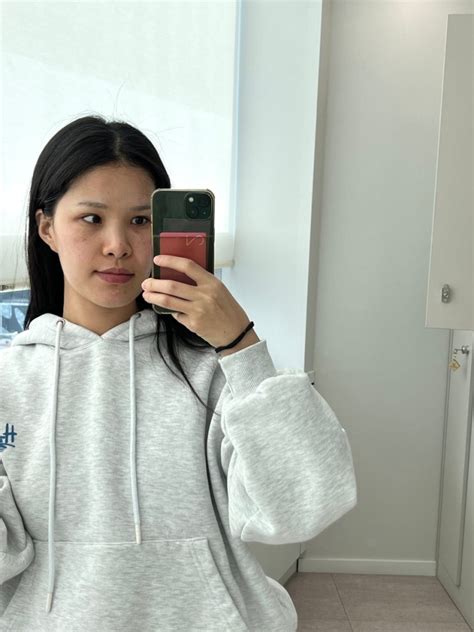 부산 서면 피부과 기미 잡티 제거 레이저 1회차 후기 네이버 블로그