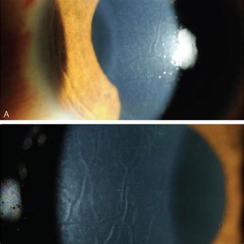 Pdf Interface Fluid Syndrome Induced By Uncontrolled Intraocular Pressure Without Triggering