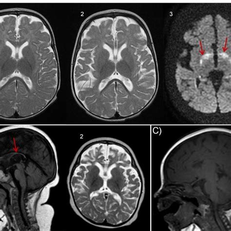 Brain Imaging A Patient 1 2 T2 Axial Mr Images Show Cortical Atrophy