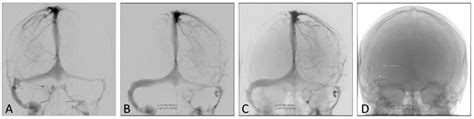 Front Carotid Angiogram Disclosing Bilateral Stenosis At The