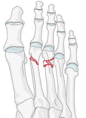 Metatarsal Neck Fracture Ankle Foot And Orthotic Centre