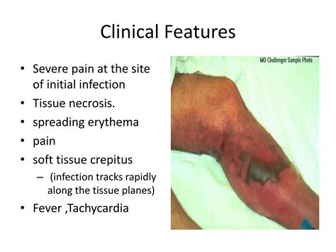 Skin And Soft Tissue Infections Pptx