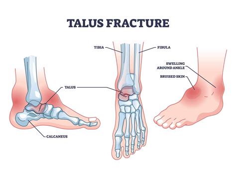 Talus Contusion