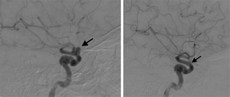 Shah Naz Khan On Linkedin An Ugly Ophthalmic Aneurysm A Beautiful Outcome With Pipeline