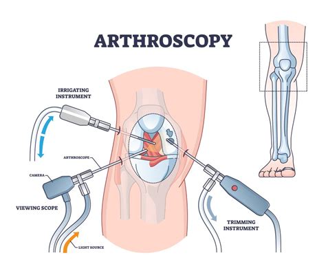 What Is Arthroscopy Or Arthroscopic Surgery What Is Arthroscopy Or Arthroscopic Surgery
