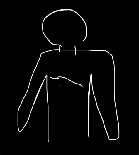 Normal Placement Of Bar R Pectusexcavatum