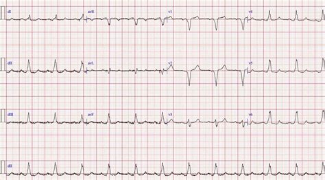 Ecgrecover A Deep Learning Approach For Electrocardiogram Signal