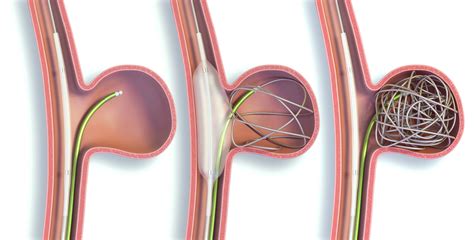 Coil Embolization Ruptured Aneurysm At Ben Vincent Blog Coil Embolization Ruptured Aneurysm At Ben Vincent Blog