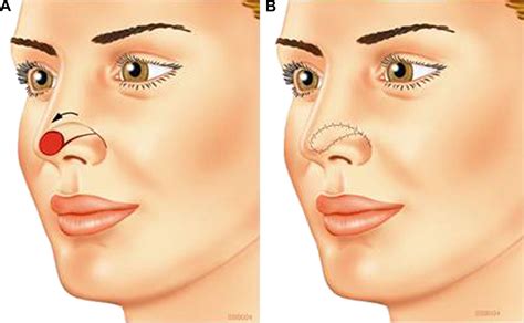 Transposition Flaps In Nasal Reconstruction Facial Plastic Surgery