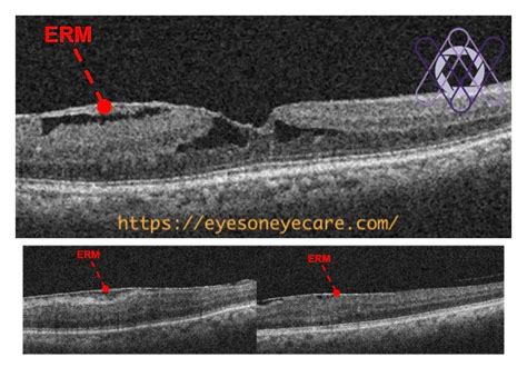 Diagnosticophthalmology Oct Perimetry Visualfield Bscan Iolmaster Topography V
