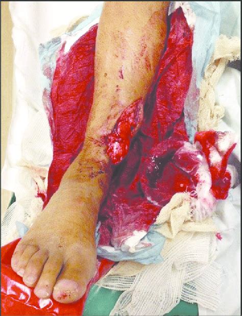 Open Fracture Of The Distal Tibia Download Scientific Diagram