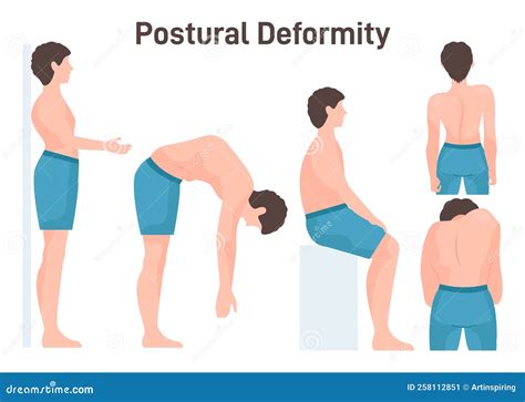 Postural Deformity Scoliosis Curvature Illness Of Spine Stock Vector Postural Deformity Scoliosis Curvature Illness Of Spine Stock Vector