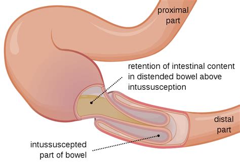 Intussusception Risk Factors Management Teachmepaediatrics