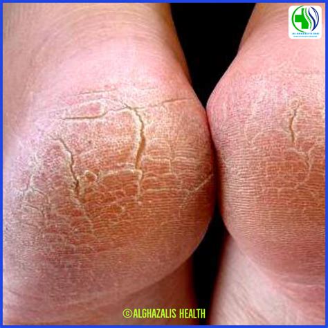 Cracked Heels And Its Management Alghazalis Health