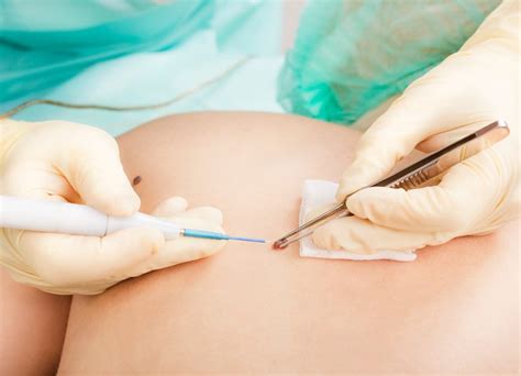 Excision Of Benign And Selected Malignant Skin Conditions Manjula Skin