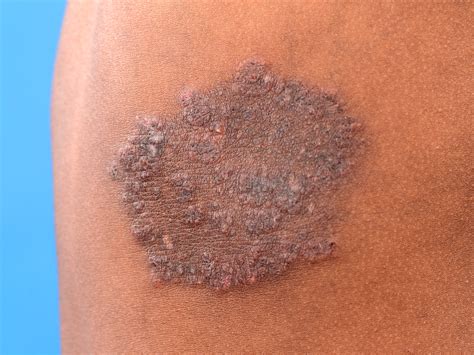 Trichophyton Ringworm Guideline For Dermatophytosis Ringworm In Cats