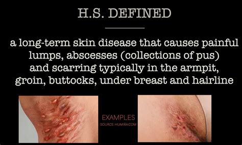 Hidradenitis Suppurativa Face