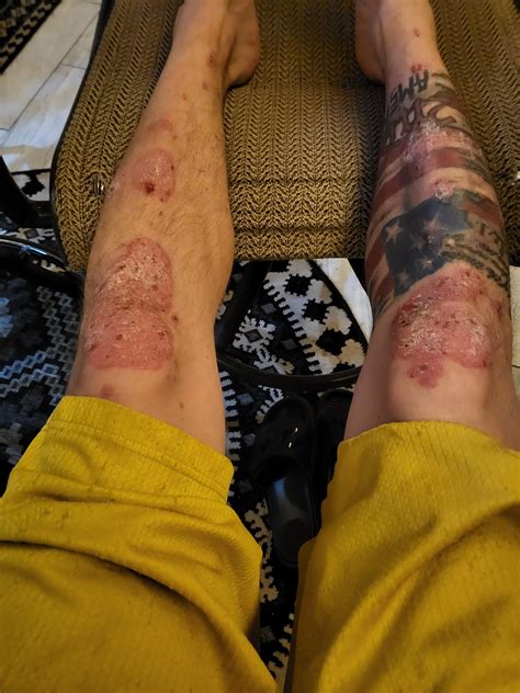 Psoriasis And Sex R Psoriasis