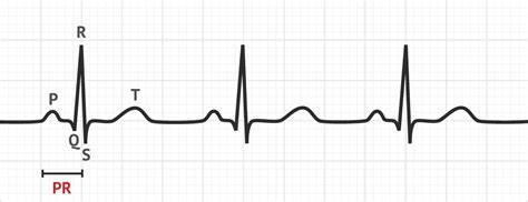 The PR Interval ECG Basics Medbabe