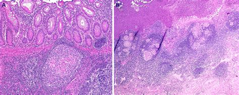 A Granulomatous Appendicitis In Confirmed Yersinia Infection B