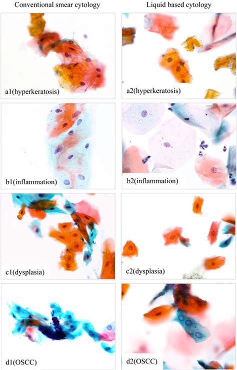 Liquid Based Cytology