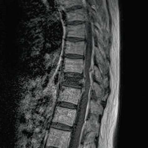 A T2 Sagittal Image Showing A Growing Extradural Mass Yellow Arrow