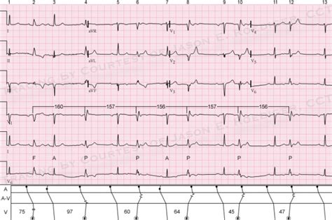 Ventricular Fusion Beat Ecg Guru Instructor Resources
