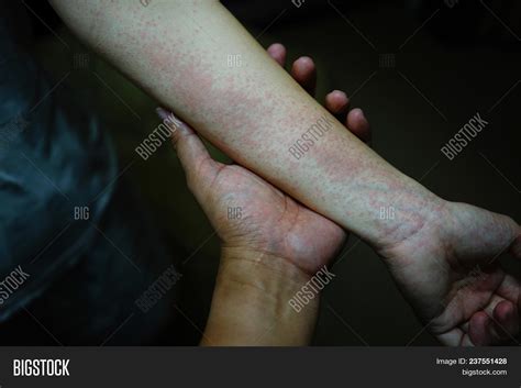 Red Itchy Bumps On Forearm