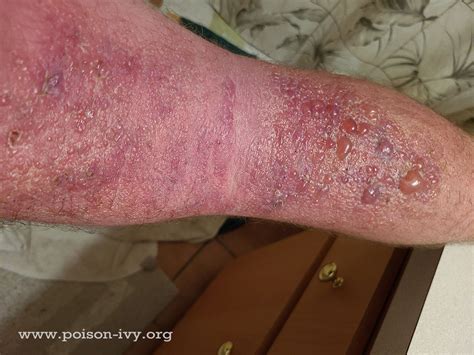 Poison Ivy Rash Expanding At Stanley Musso Blog