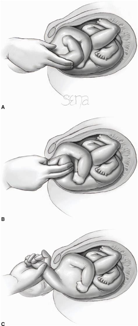 Zavanelli Maneuver Labour And Birth Rphcm