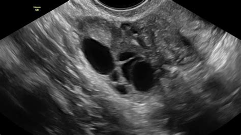 Endometriosis Transvaginal Ultrasound