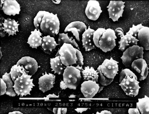 Laboratorio Clinico Alteraciones De Los Eritrocitos