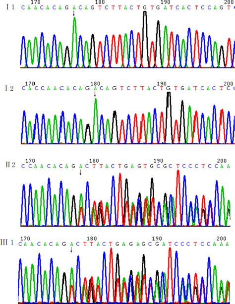 Identification Of A Novel De Novo Mutation Of Setbp1 And New Findings